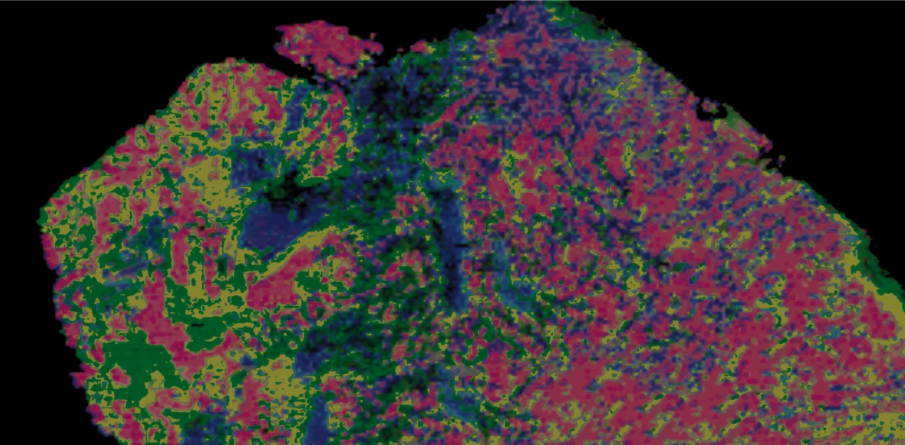 LabCast: Targeted Analysis of Proteins in Breast Cancer using the MALDI ...