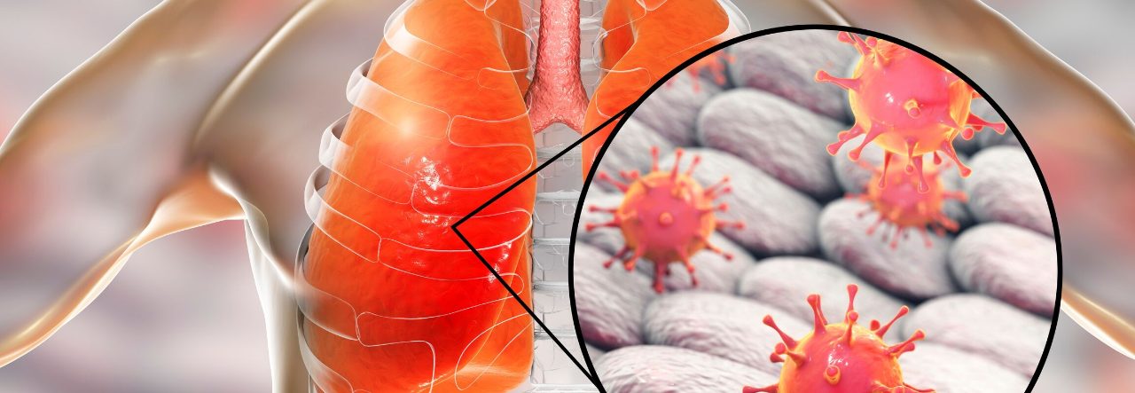 Plasma Metabolomics in H1N1 Influenza Pneumonia Diagnosis | Bruker