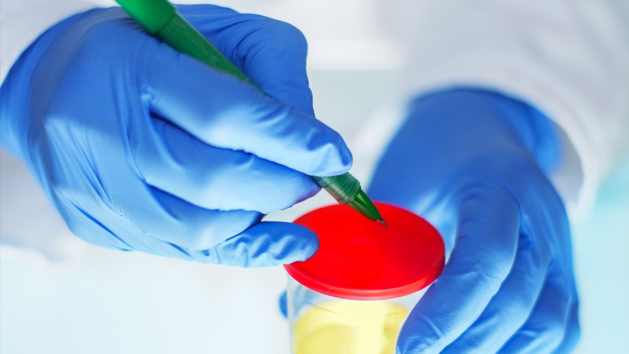 Moving Away From Immunoassays: Adapting LC-MS for Routine Urine ...