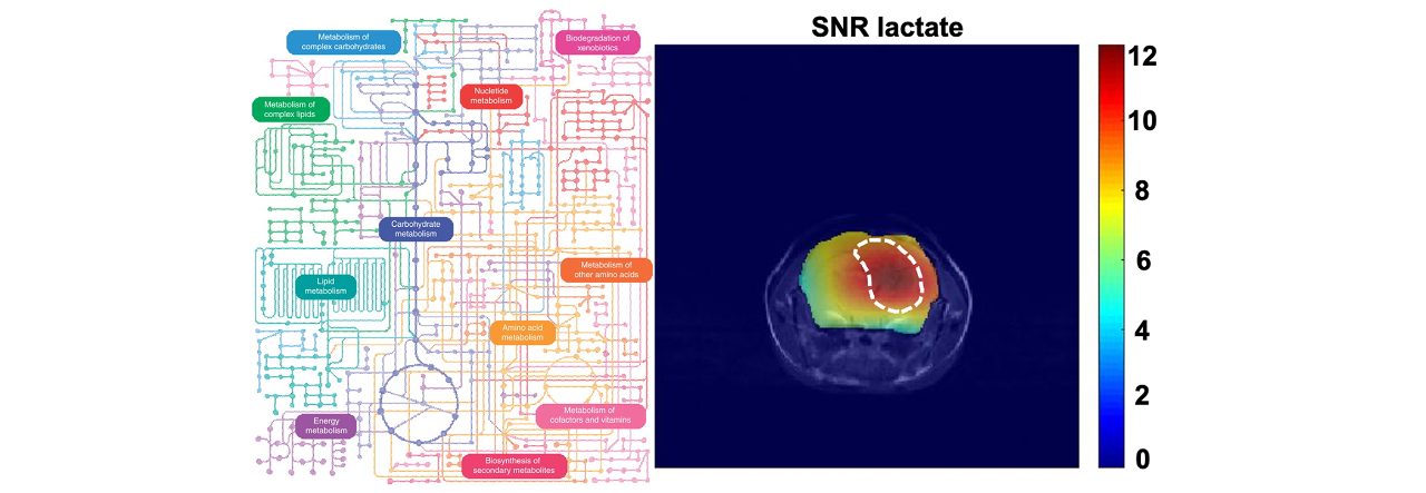Non-invasive metabolic imaging of oncogenic events in brain tumors | Bruker