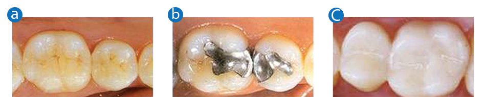 Dental Restorative Composites: Effect of Polymerization and Time on ...