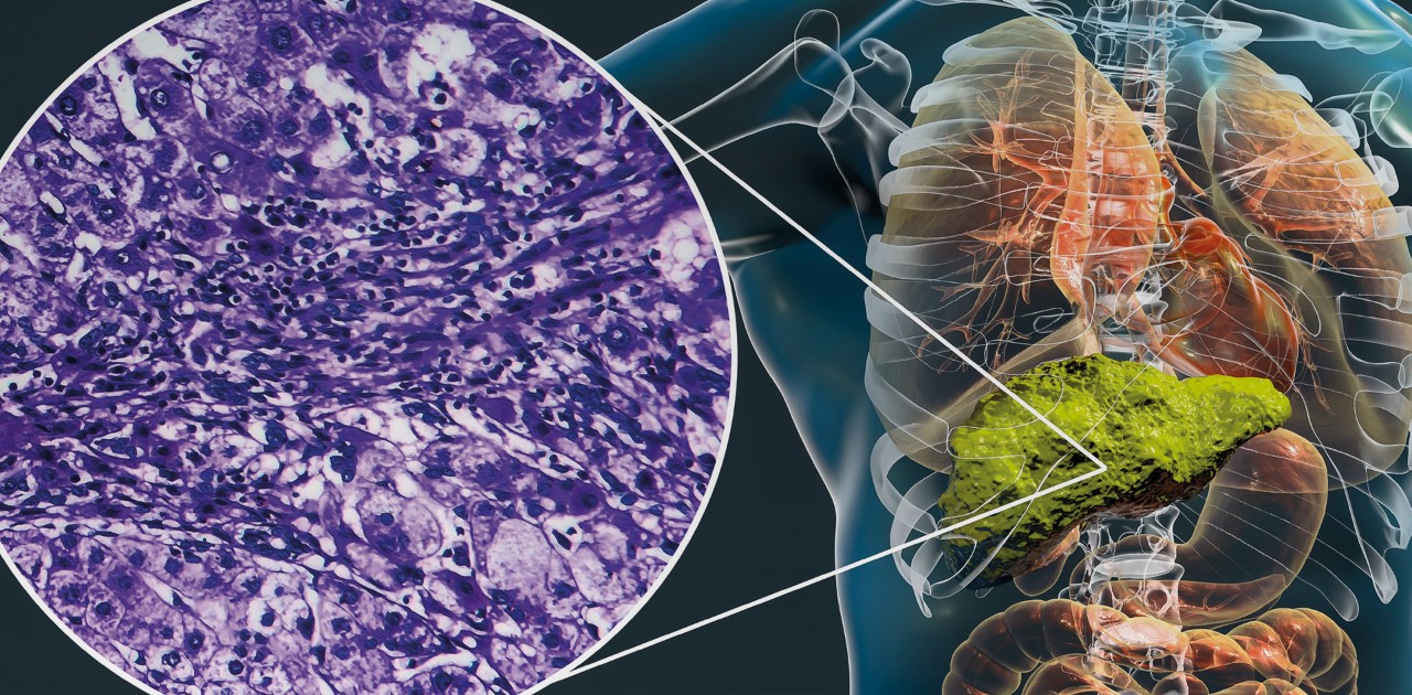 LabCast: Biomarkers for liver cancer using N-Glycan MALDI Imaging | Bruker